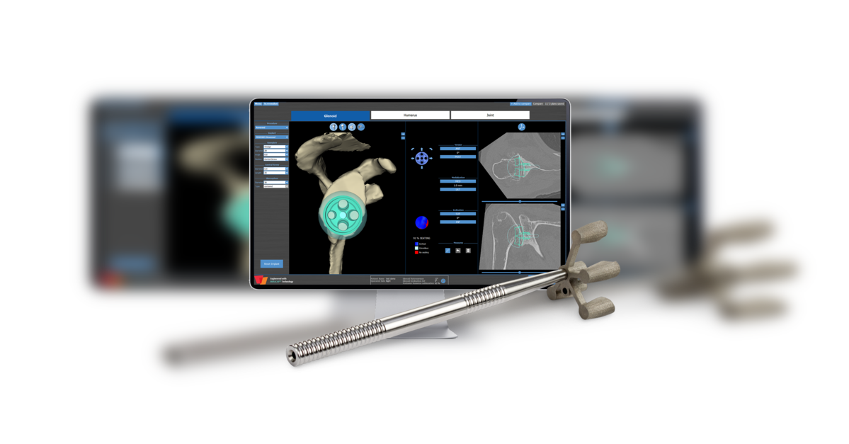 Stryker India: Stryker launches the Tornier Perform Humeral System and ...