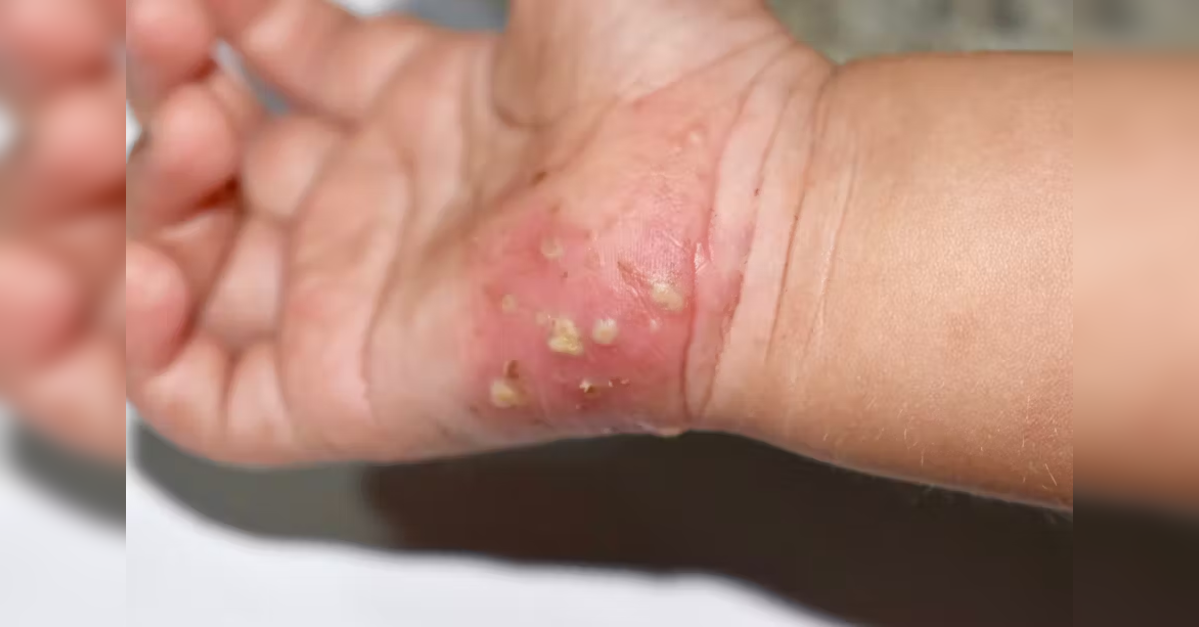 Scabies: what to know about the outbreak of this contagious skin ...