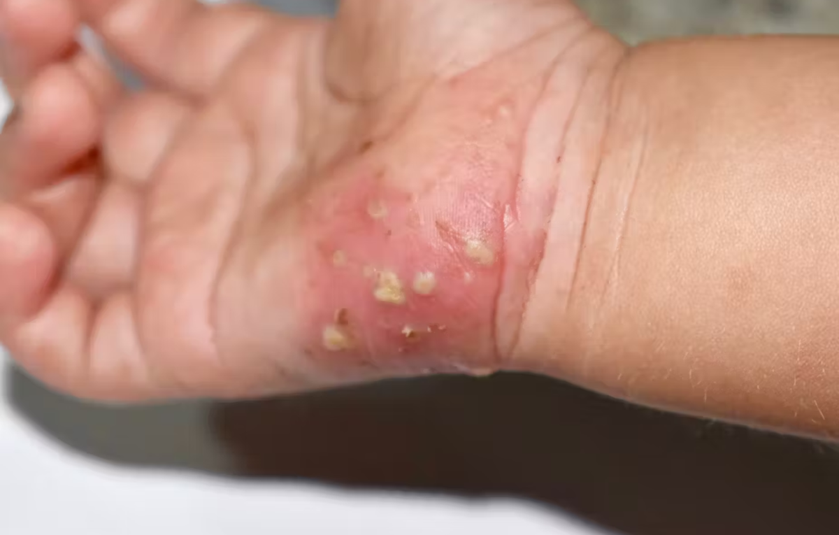 Scabies: what to know about the outbreak of this contagious skin ...