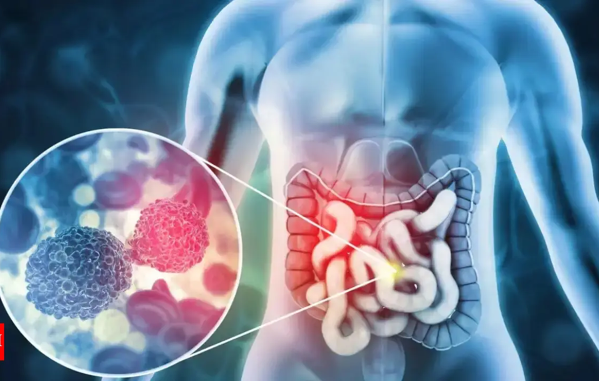Childhood exposure to bacterial toxin can trigger Colorectal cancer ...