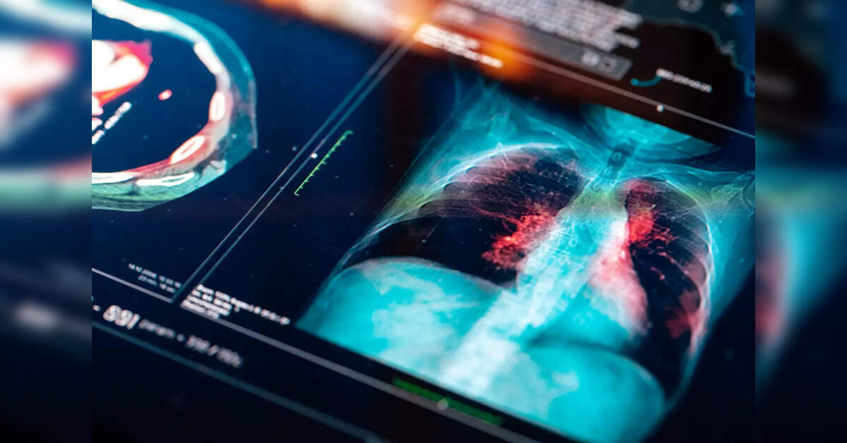 aTyr Pharma's lung disease drug misses main goal in late-stage trial ...