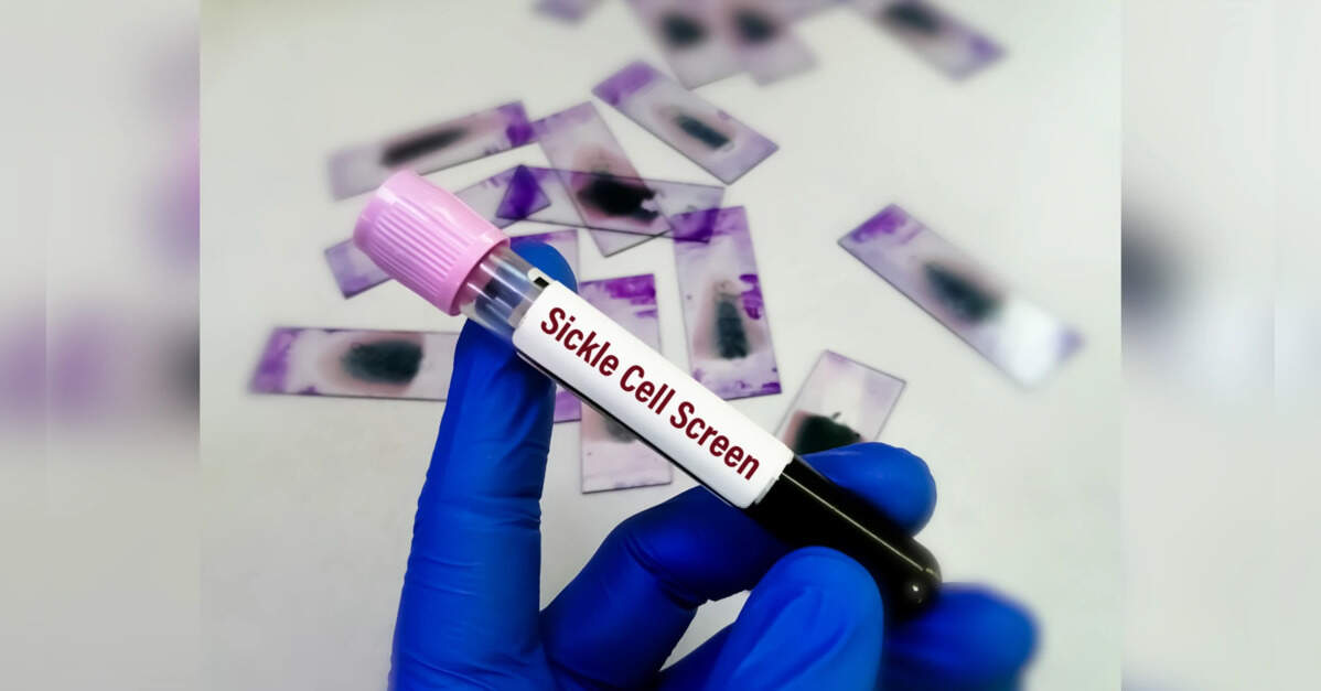 Statewide drive for screening sickle cell anaemia soon, ETHealthworld