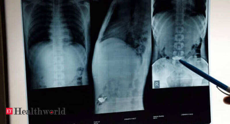 Mumbai doctors perform rare surgery on Bamboo Spine patient, Health ...