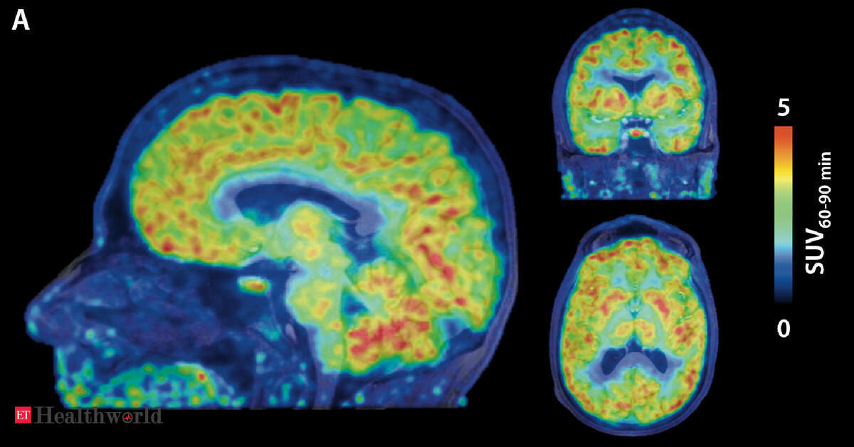 New PET scan tracer allows first imaging of the epigenetics of the ...