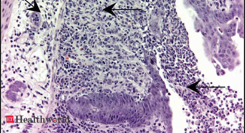 Diarrhea-Causing Bacteria Promote Growth of Crohn’s-Linked Microbe in ...