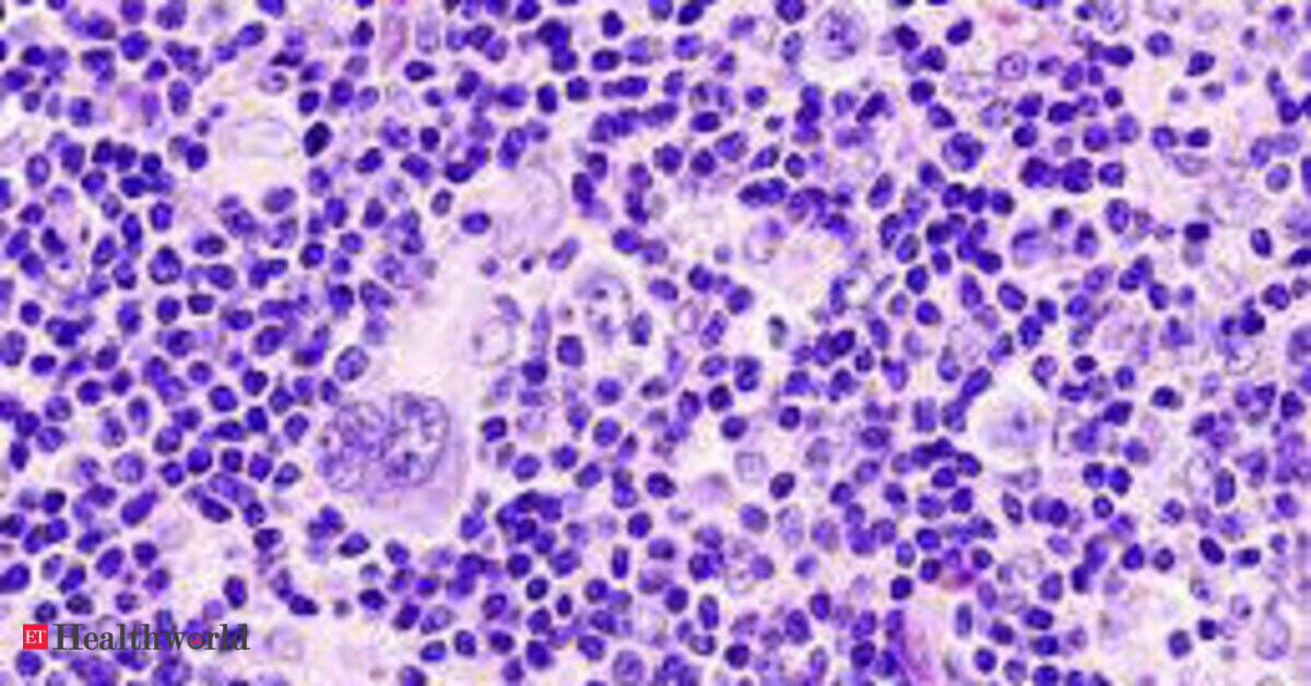 Epigenetics provides new insights into the pathogenesis of lymphoma ...