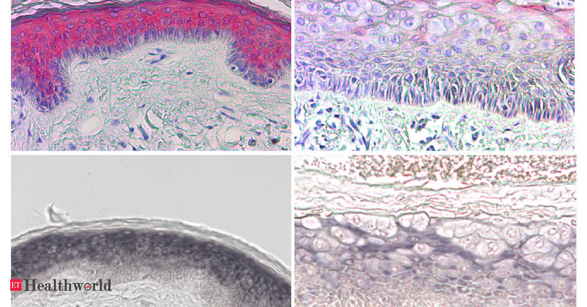 Scientists uncover potential mechanism for HPV-Induced skin cancer ...