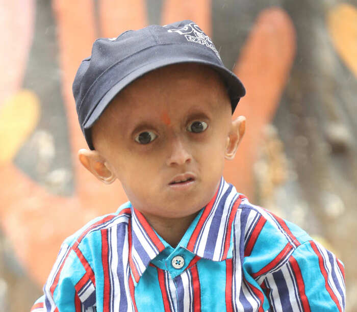 Progeria awareness in India, Health News, ET HealthWorld