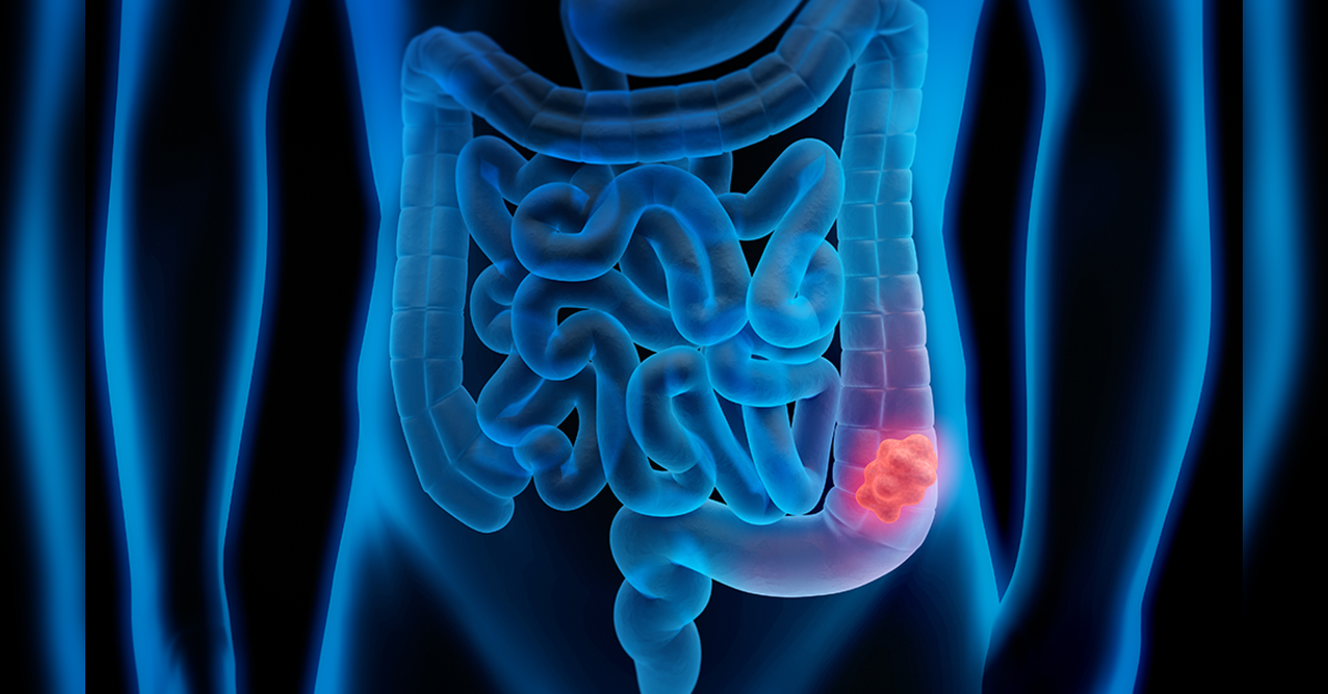 Processed foods raise risk of colorectal cancer?, ETHealthworld